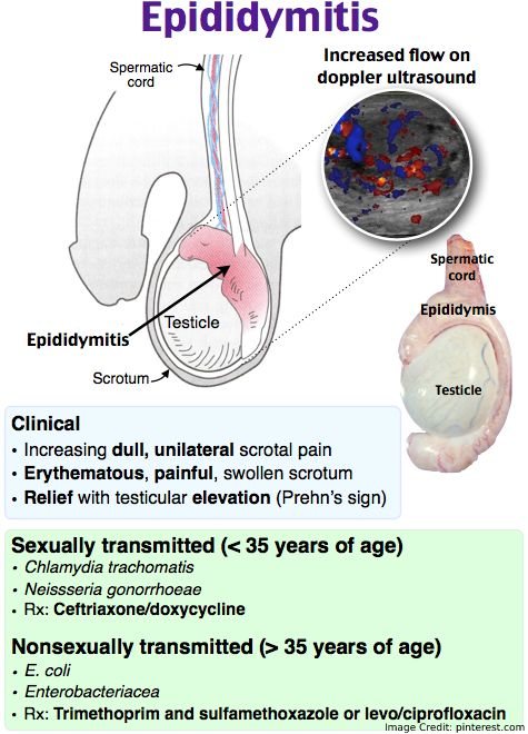 Epididymitis What Is It Symptoms Causes Diagnosis 54 Off