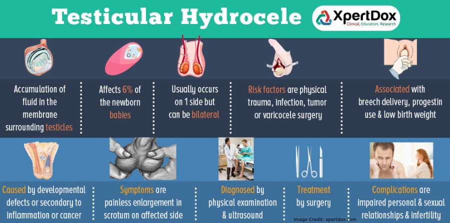 Testicular Hydrocele Everything You Wanted To Know